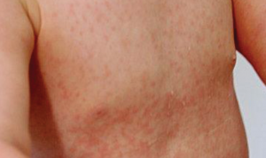 Herpes HHV-6 e HHV-7 – Clinica Lambertucci